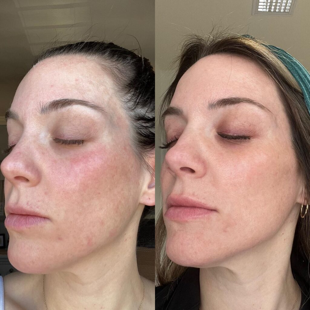 VI Peel : Institute for Laser Medicine