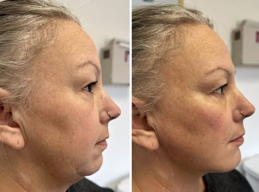 Sculptra Aesthetic : Institute for Laser Medicine